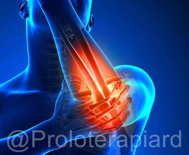 USO DEL PRP Y DE LAS CÉLULAS MADRE PARA EL TRATAMIENTO DEL CODO DE ...